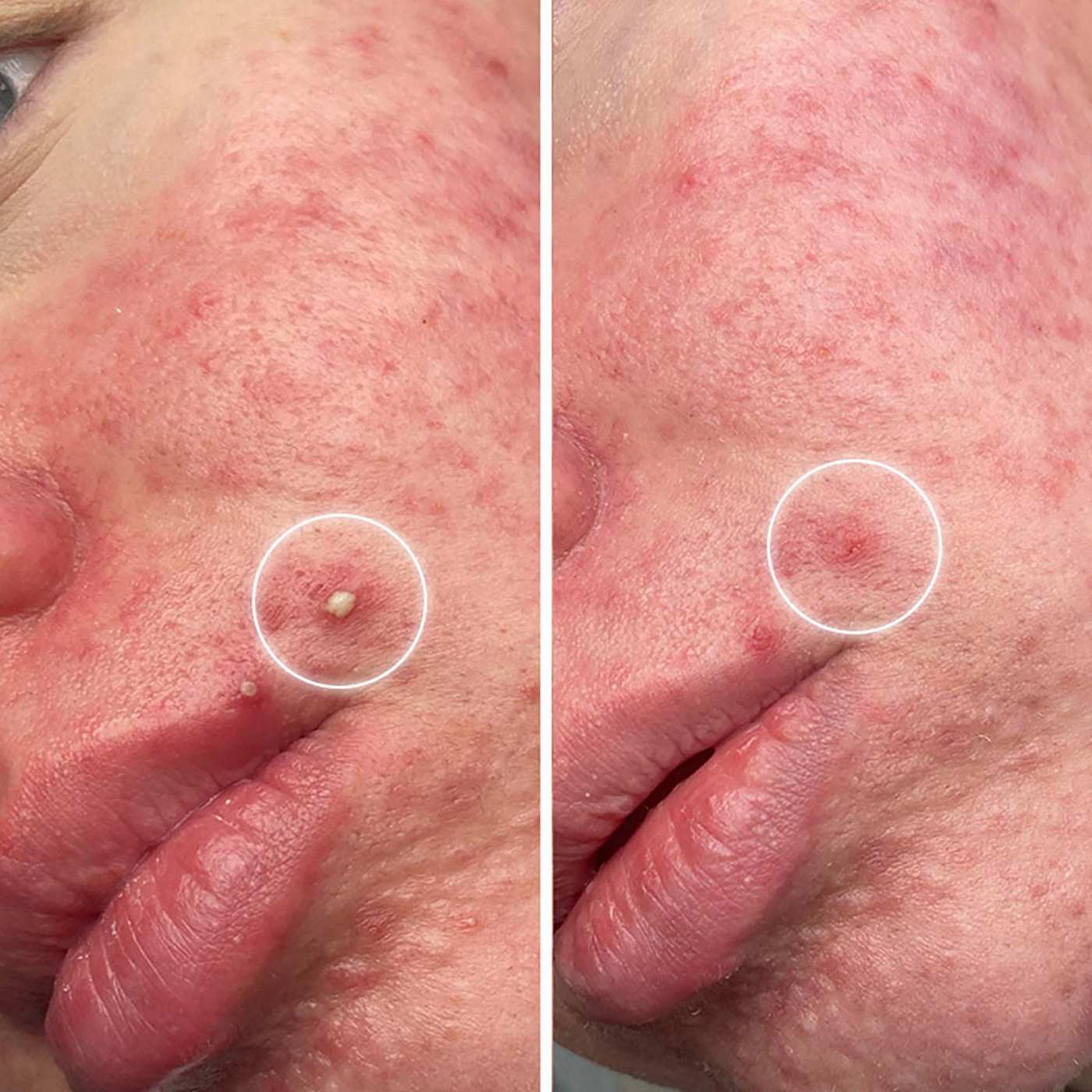 Zitsticka Goo Getter Surface Extraction Dots - Shop Facial cleansers ...